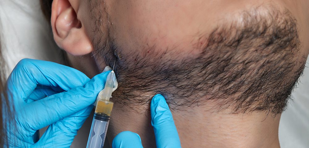 Transplante de barba potencializa a autoestima do homem - Clínica ...